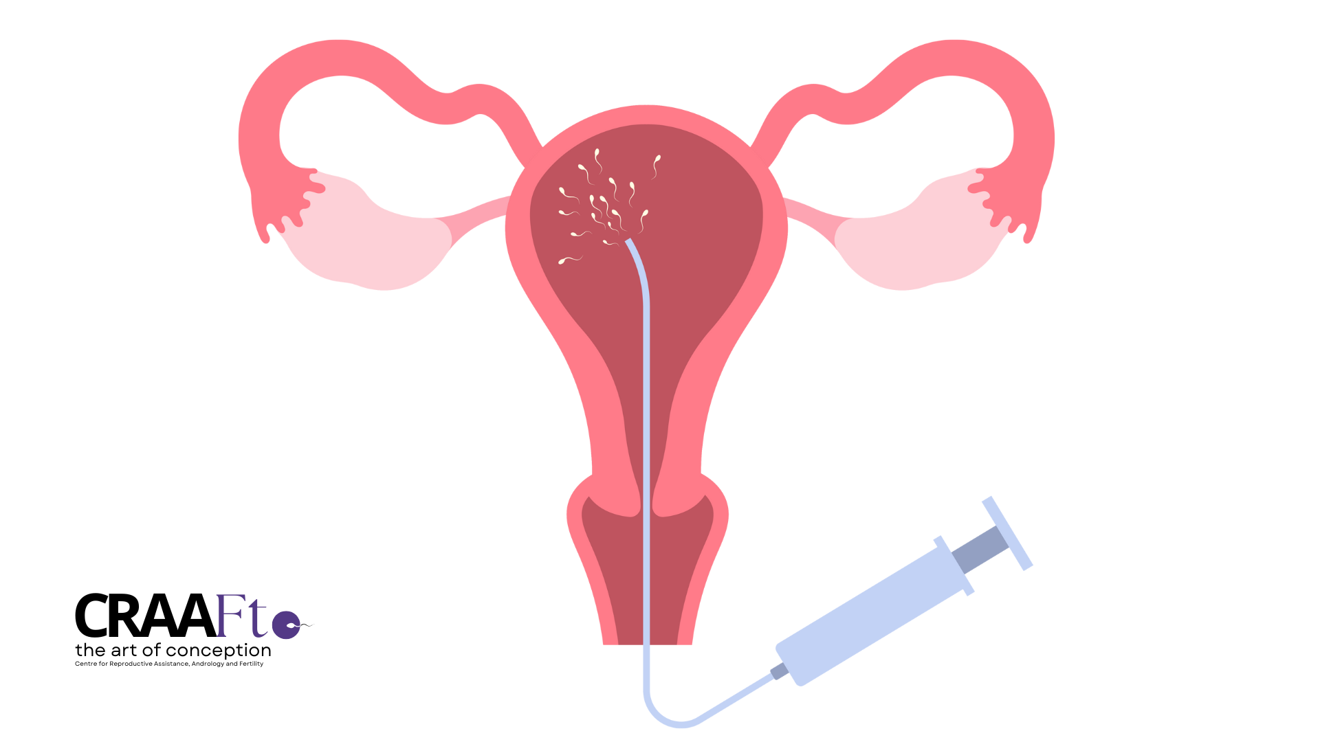 Intrauterine Insemination: IUI - CRAAFt IVF Centre